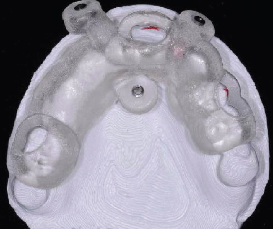 A Digital Approach to Immediate Placement with Implant Concierge