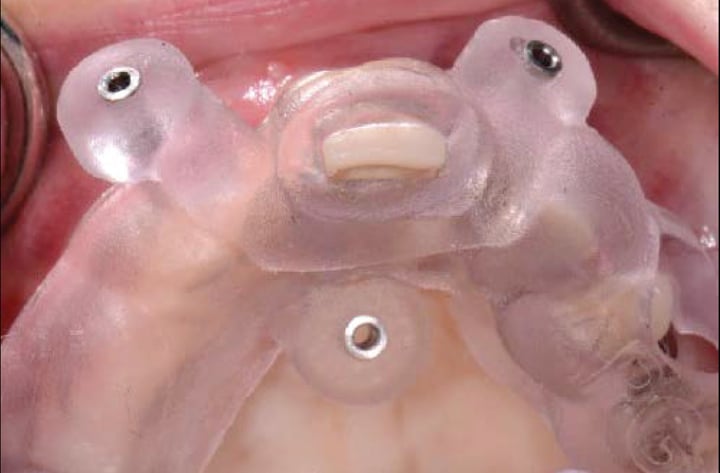 A Digital Approach to Immediate Placement with Implant Concierge