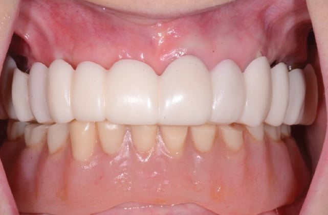 A Digital Approach to Immediate Placement with Implant Concierge