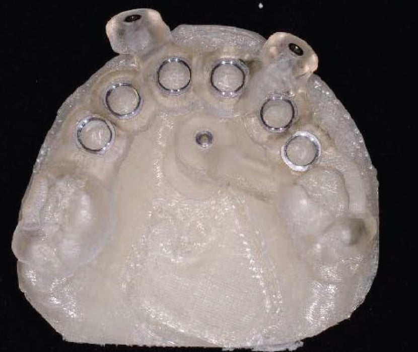 A Digital Approach to Immediate Placement with Implant Concierge