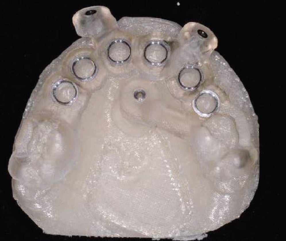 A Digital Approach to Immediate Placement with Implant Concierge