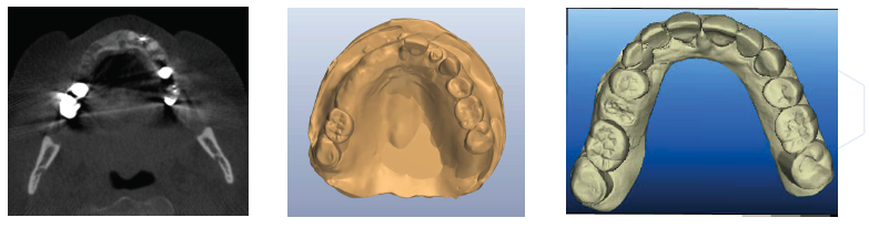 A Digital Approach to Immediate Placement with Implant Concierge