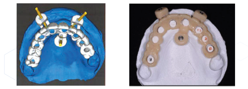 A Digital Approach to Immediate Placement with Implant Concierge