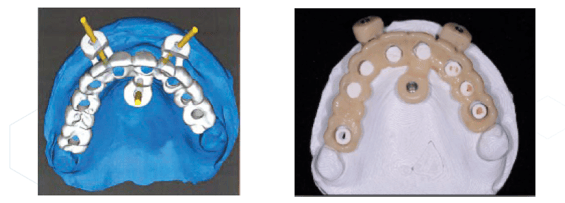 A Digital Approach to Immediate Placement with Implant Concierge