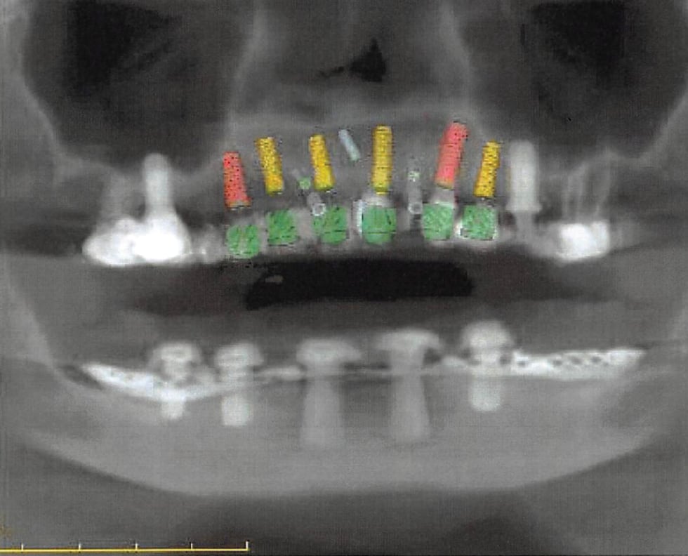 A Digital Approach to Immediate Placement with Implant Concierge