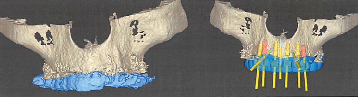 A Digital Approach to Immediate Placement with Implant Concierge